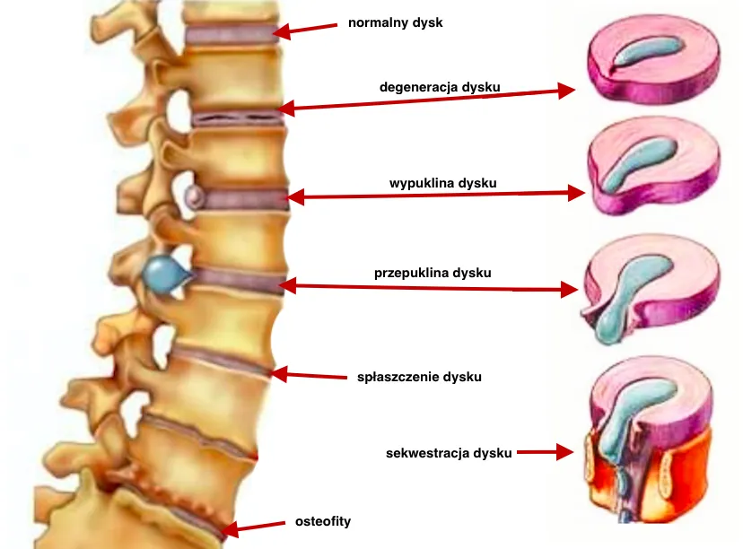 Objawy dyskopatii lędźwiowej: jak rozpoznać i kiedy do lekarza
